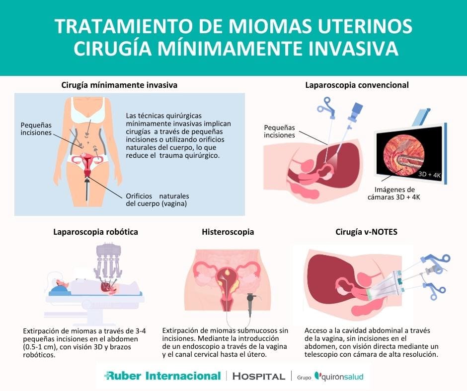Miomas Uterinos: Síntomas, Diagnóstico y Tratamientos Avanzados